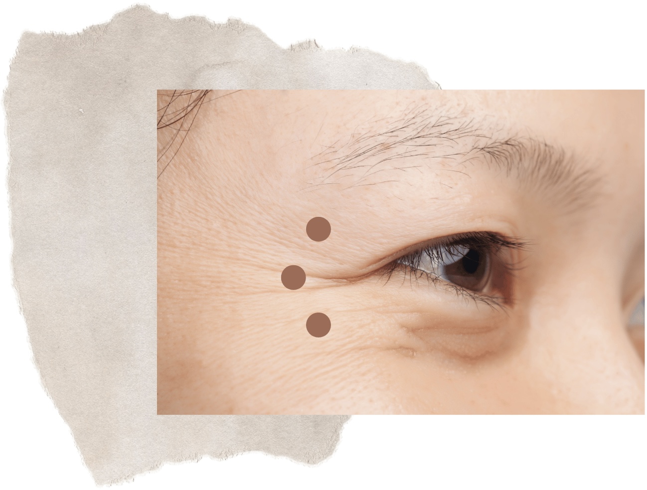 WRINKLES - IKIGAI MEDICAL