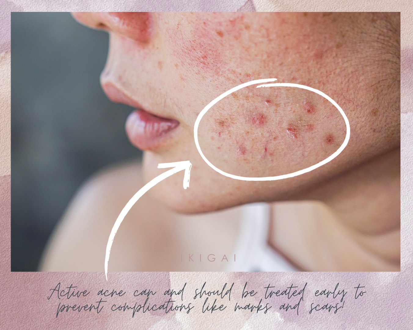 ACNE AND ACNE SCARS - IKIGAI MEDICAL
