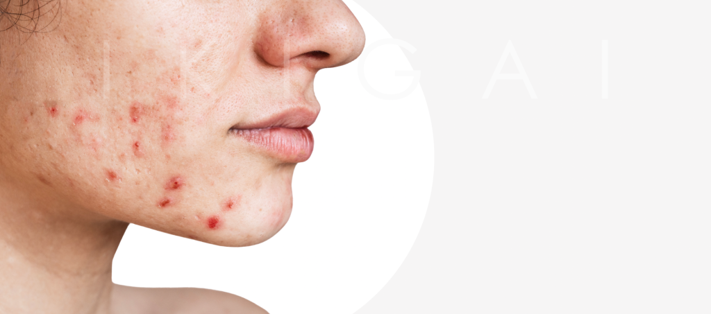 ACNE AND ACNE SCARS - IKIGAI MEDICAL